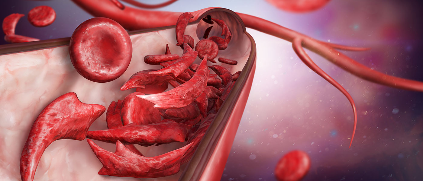 CWRU Researchers Secure 2 Million NIH Grant To Test Portable Sickle 